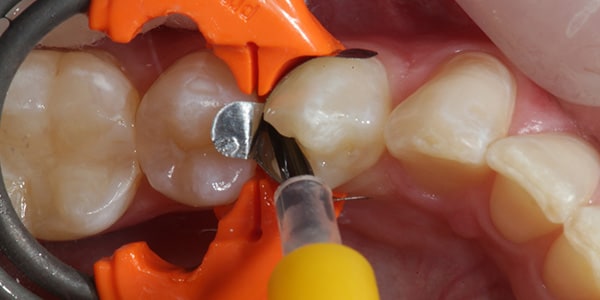 Optimizing Aesthetics and Predictability in the Placement of Posterior ...
